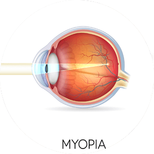 Laser Ματιών Μυωπίας & Υπερμετρωπίας - Laser Eye Center